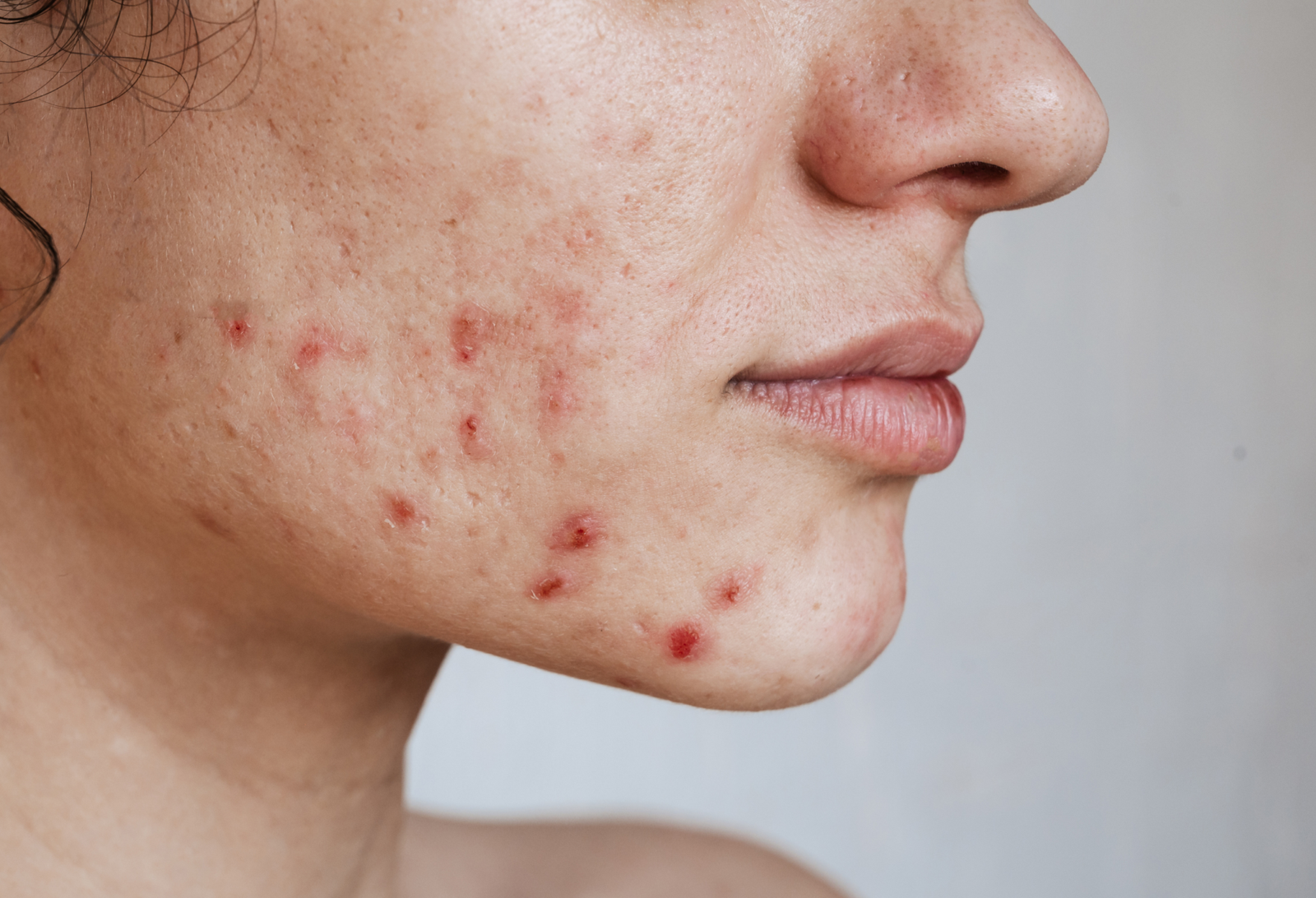 How to Treat and Prevent Adult Acne: A Comprehensive Guide ...