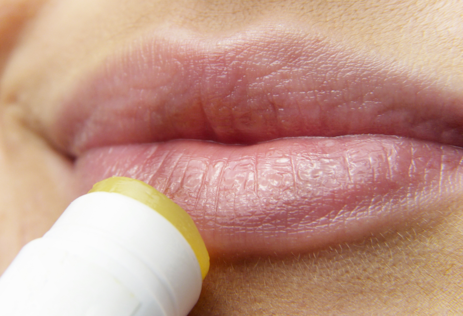 The Ultimate Solution to a Pimple Under the Lip: Effective Remedies and ...